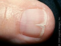 Ridges in Fingernails: 8 Health Warnings Your Fingernails May Be Sending